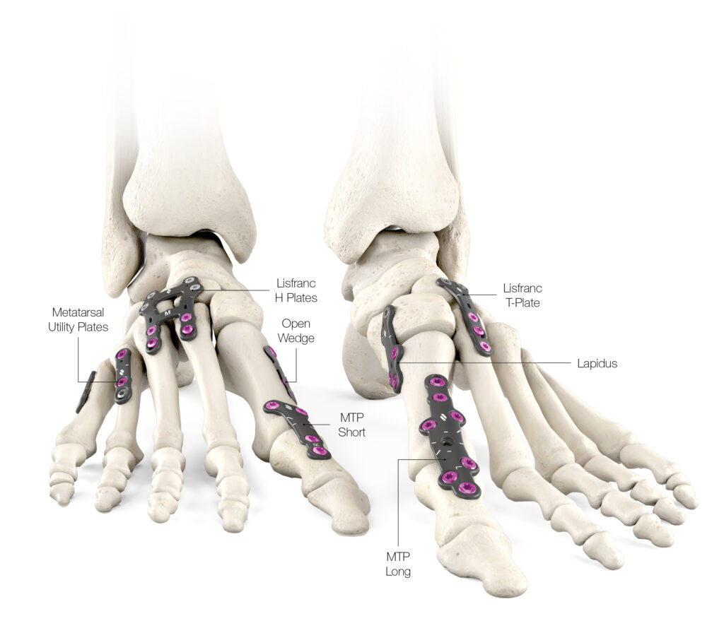 Enovis AirLock Plating - Valor Medical