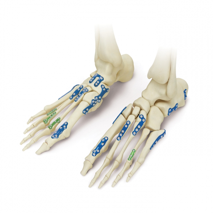 Enovis Arsenal Plating - Valor Medical