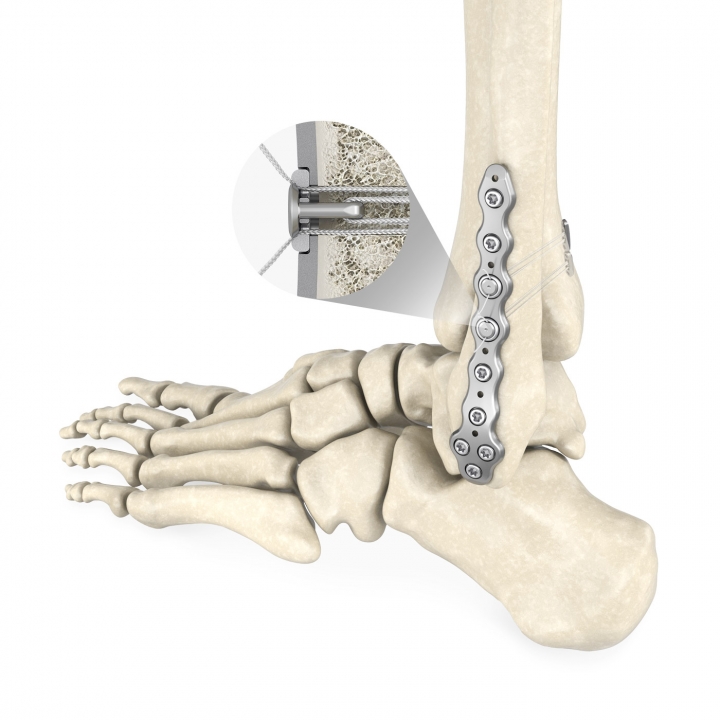 Enofix Syndesmosis Repair System - Valor Medical
