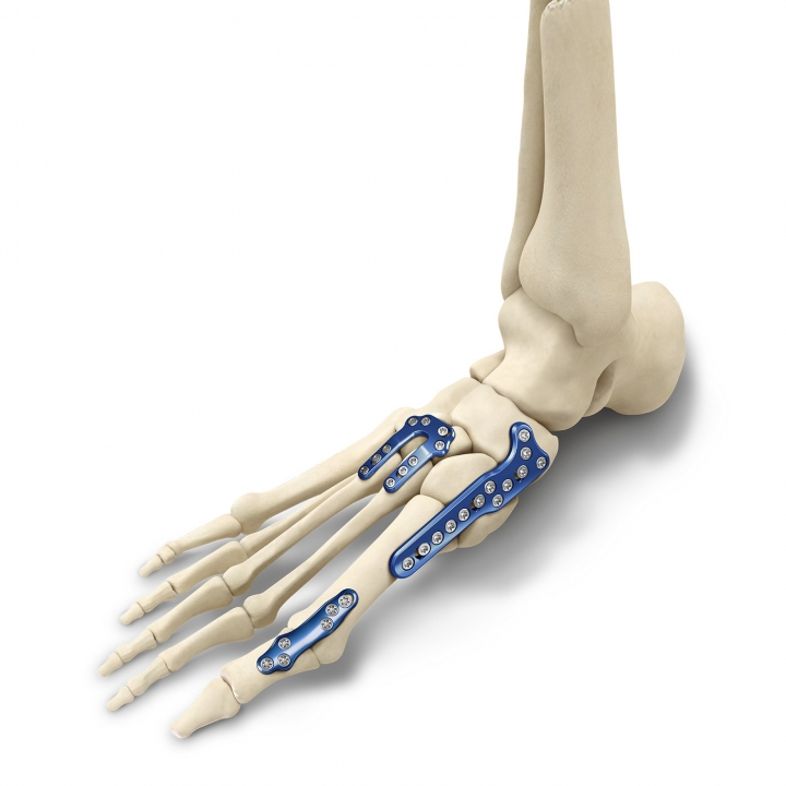 Enovis Arsenal Plating - Valor Medical