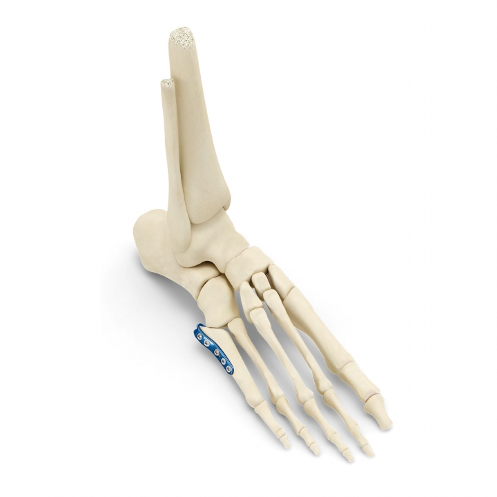 Enovis Arsenal Plating - Valor Medical