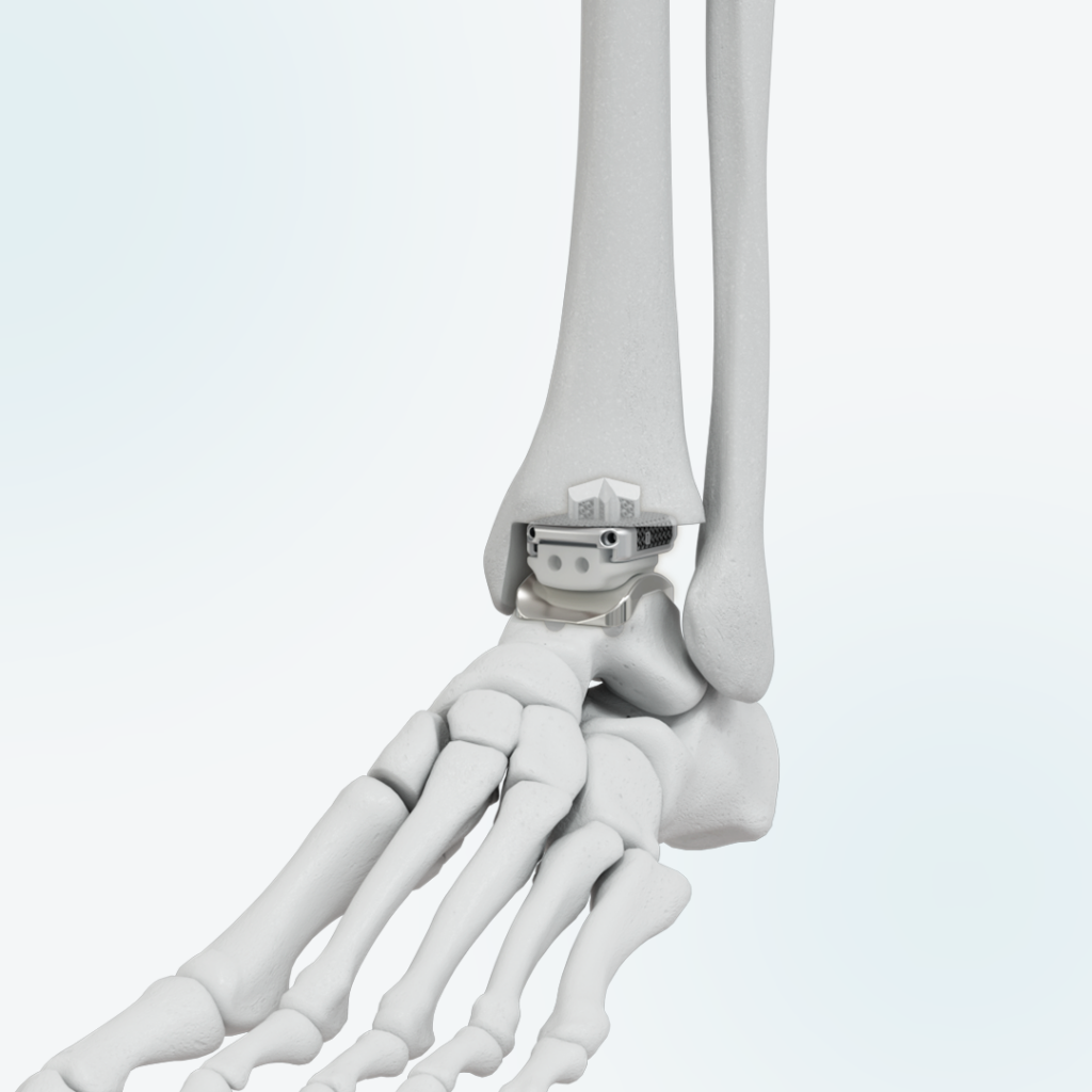 ORTHO RECON - Valor Medical